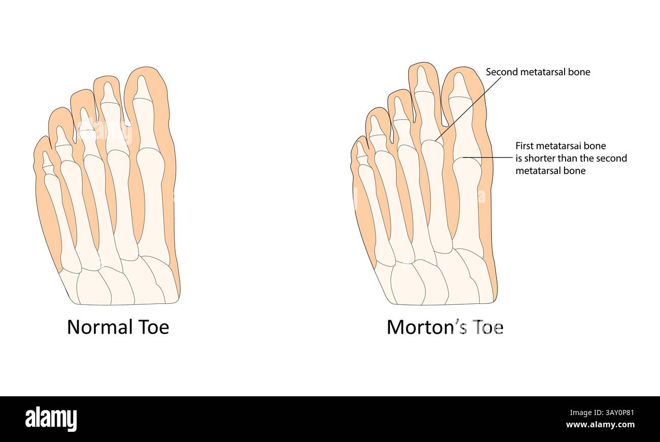 Morton's toe vector illustration. Greek toe Stock Vector Image & Art ...