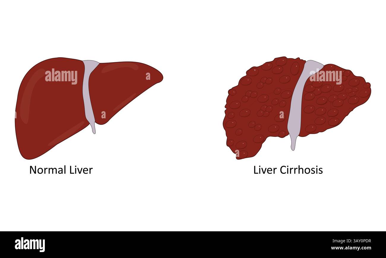 Liver cirrhosis disease vector illustration Stock Vector Image & Art ...