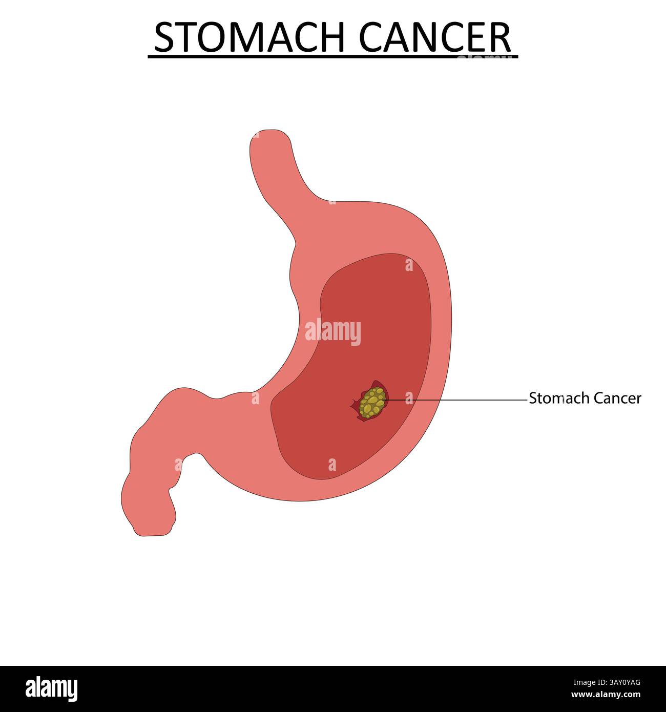 Cancer of the stomach vector illustration Stock Vector Image & Art - Alamy