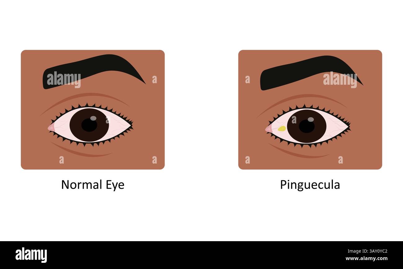 Pinguecula hi-res stock photography and images - Alamy