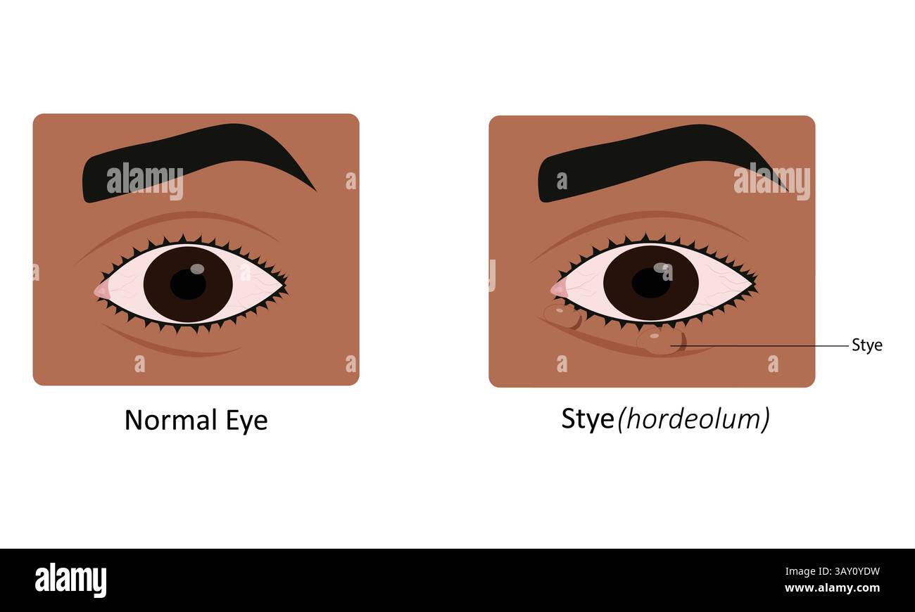 Stye eye Stock Vector Images - Alamy