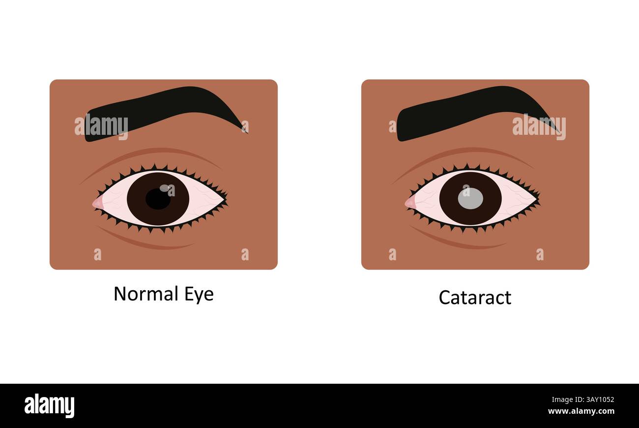 Cataract eye disease vector illustration Stock Vector Image & Art - Alamy