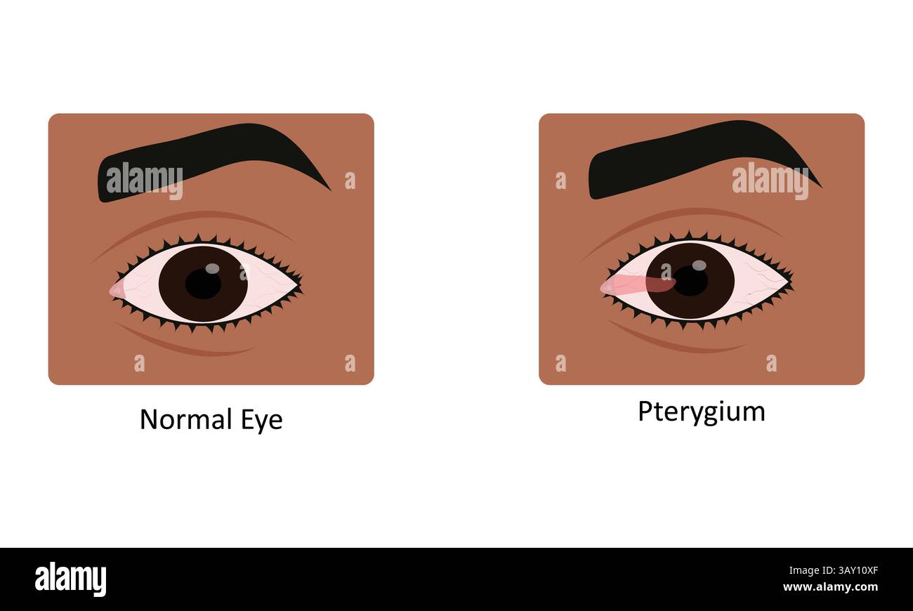 Pterygium eye disease vector illustration Stock Vector Image & Art - Alamy
