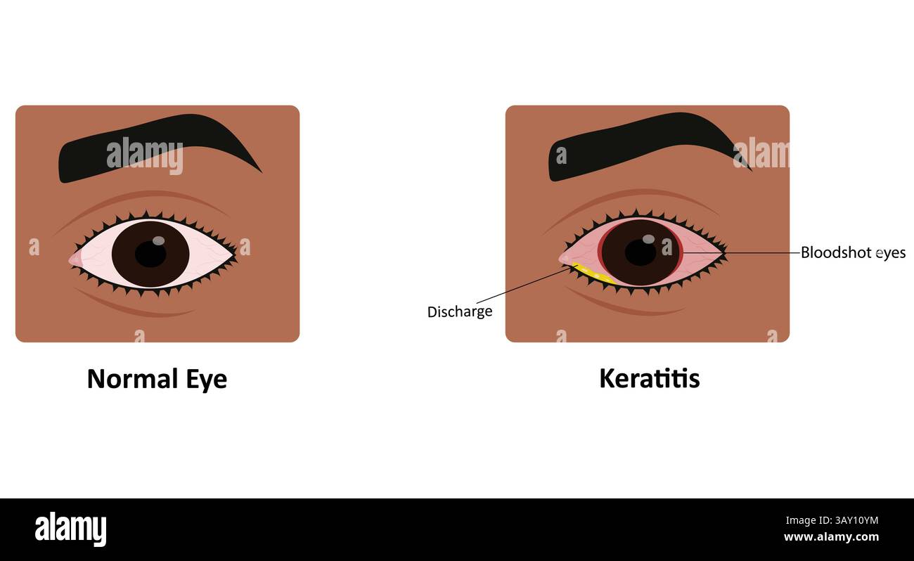 Keratitis eye disease vector illustration Stock Vector Image & Art - Alamy