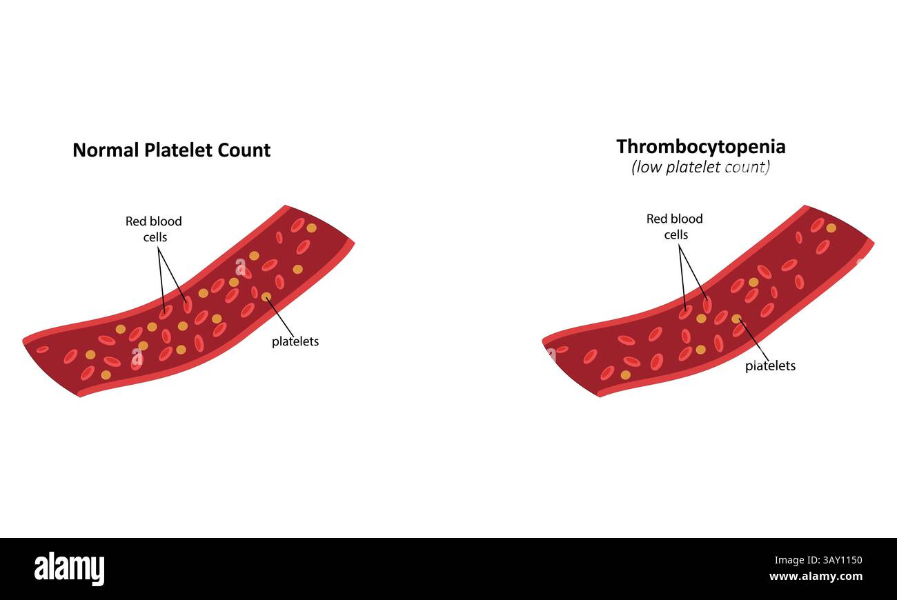 Thrombocytopenia Vector Illustration Low Platelet Count Stock Vector