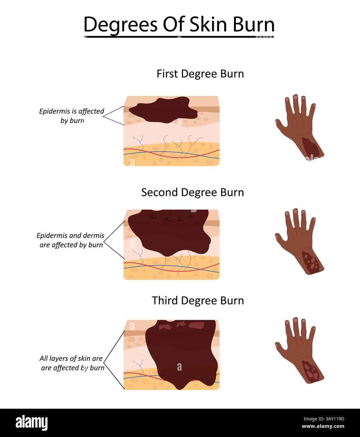 Scald burn Stock Vector Images - Alamy