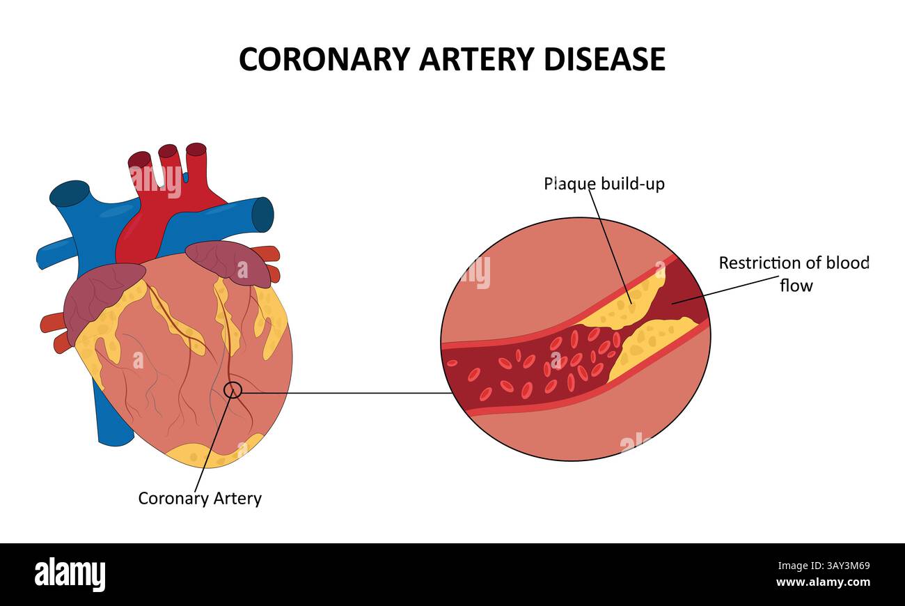 Coronary Artery Disease vector illustration Stock Vector Image & Art ...