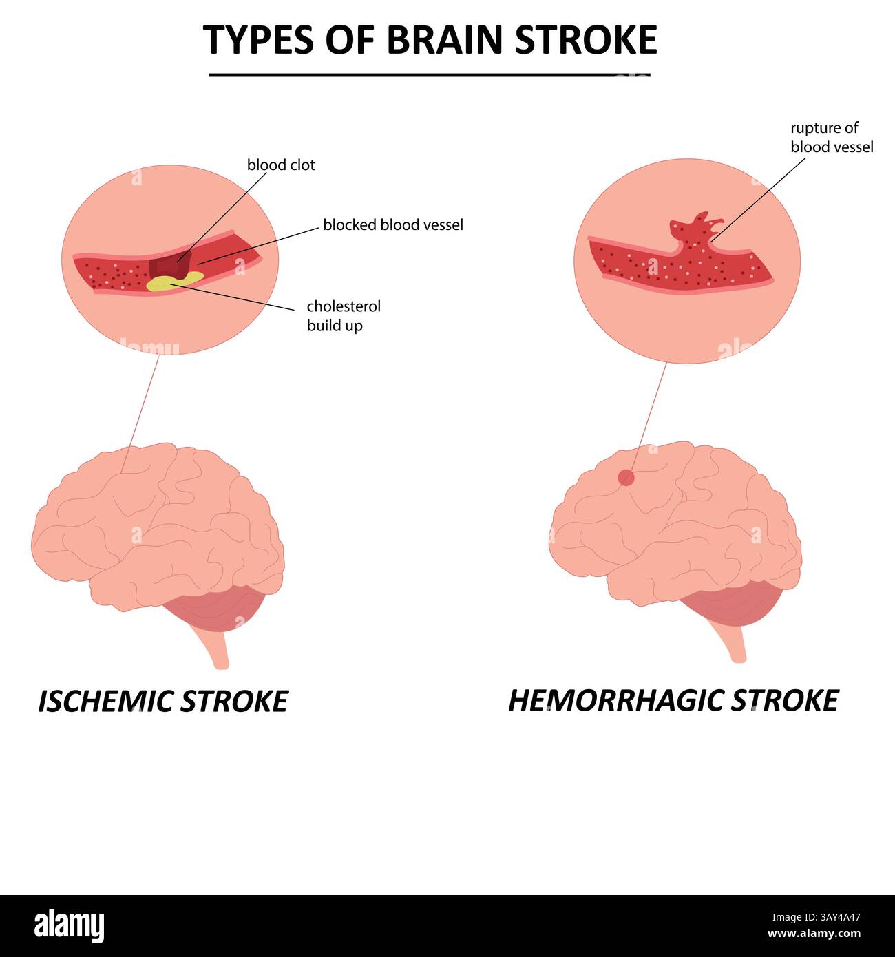Vector infographic of ischemic stroke and hemorrhagic stroke Stock ...