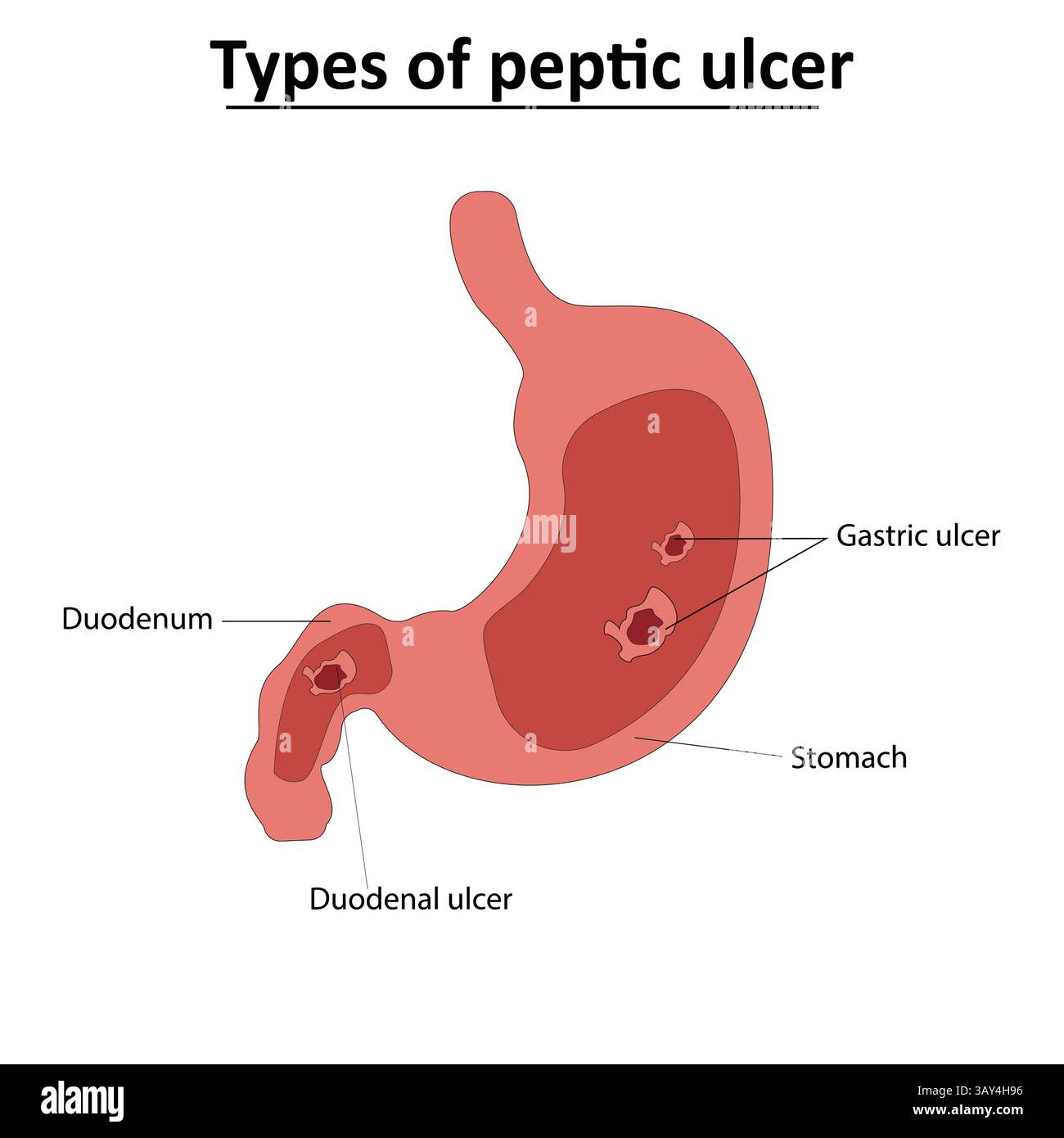 Sore belly Stock Vector Images - Alamy