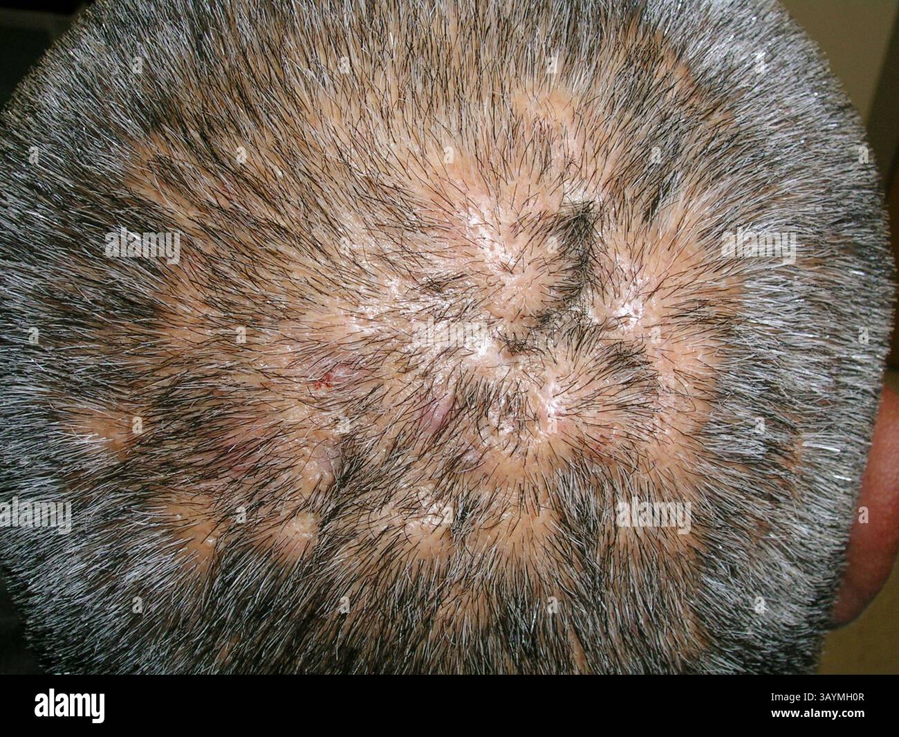 Dissecting cellulitis on a patient's scalp. This scalp condition is a ...