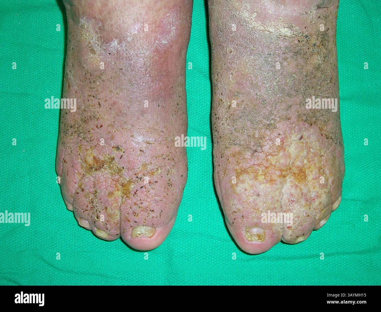 Elephantiasis of the feet. Elephantiasis, also known as lymphatic ...