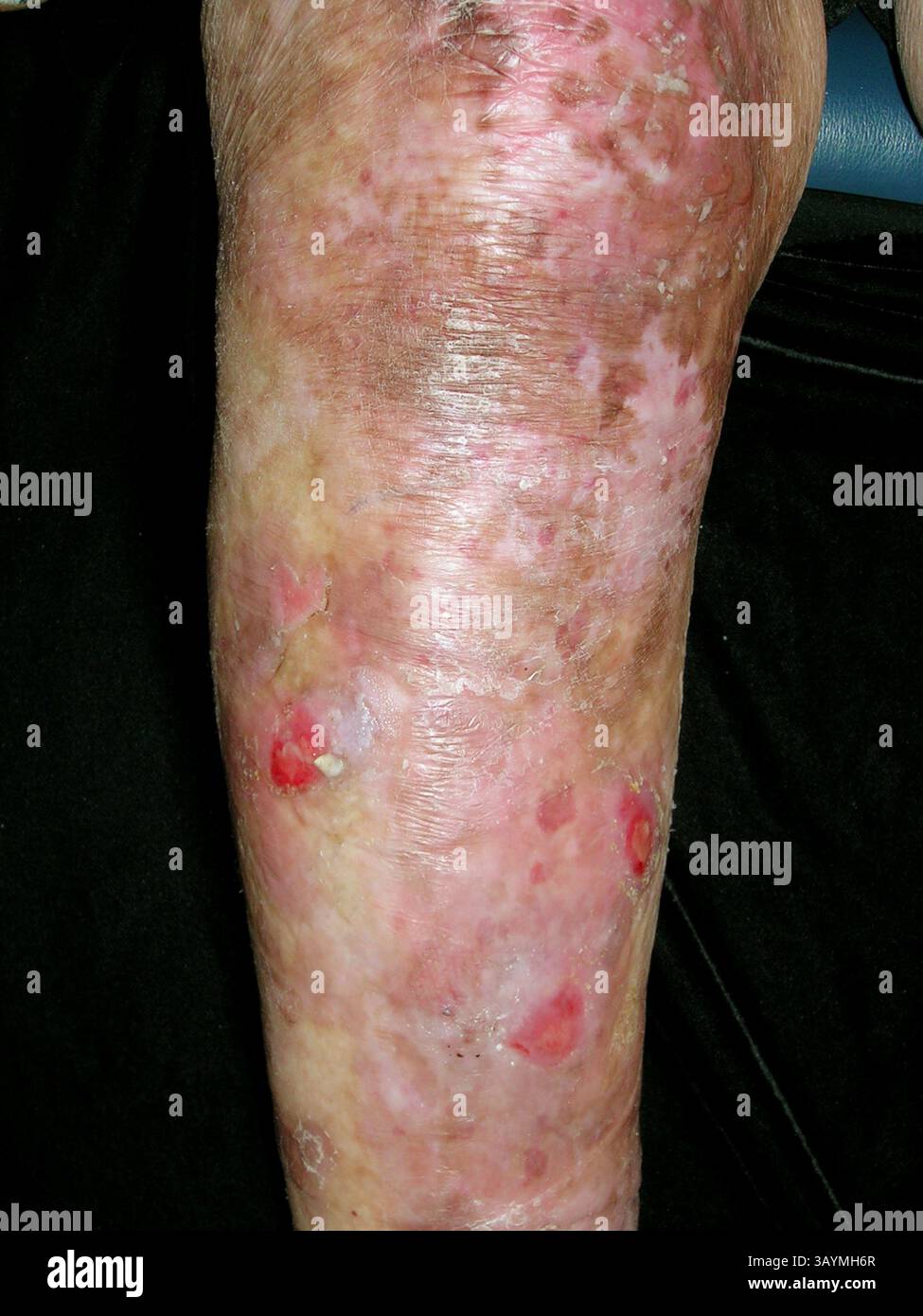 Epidermolysis bullosa (EB) blister on the leg of a 31 year old female ...