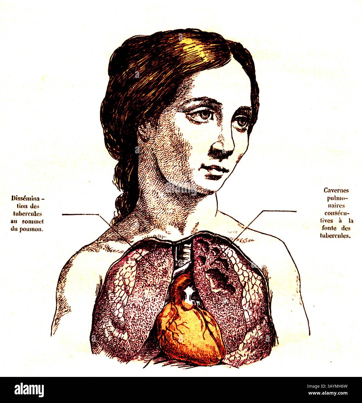Illustration showing the symptoms of pulmonary (lung) tuberculosis, a ...