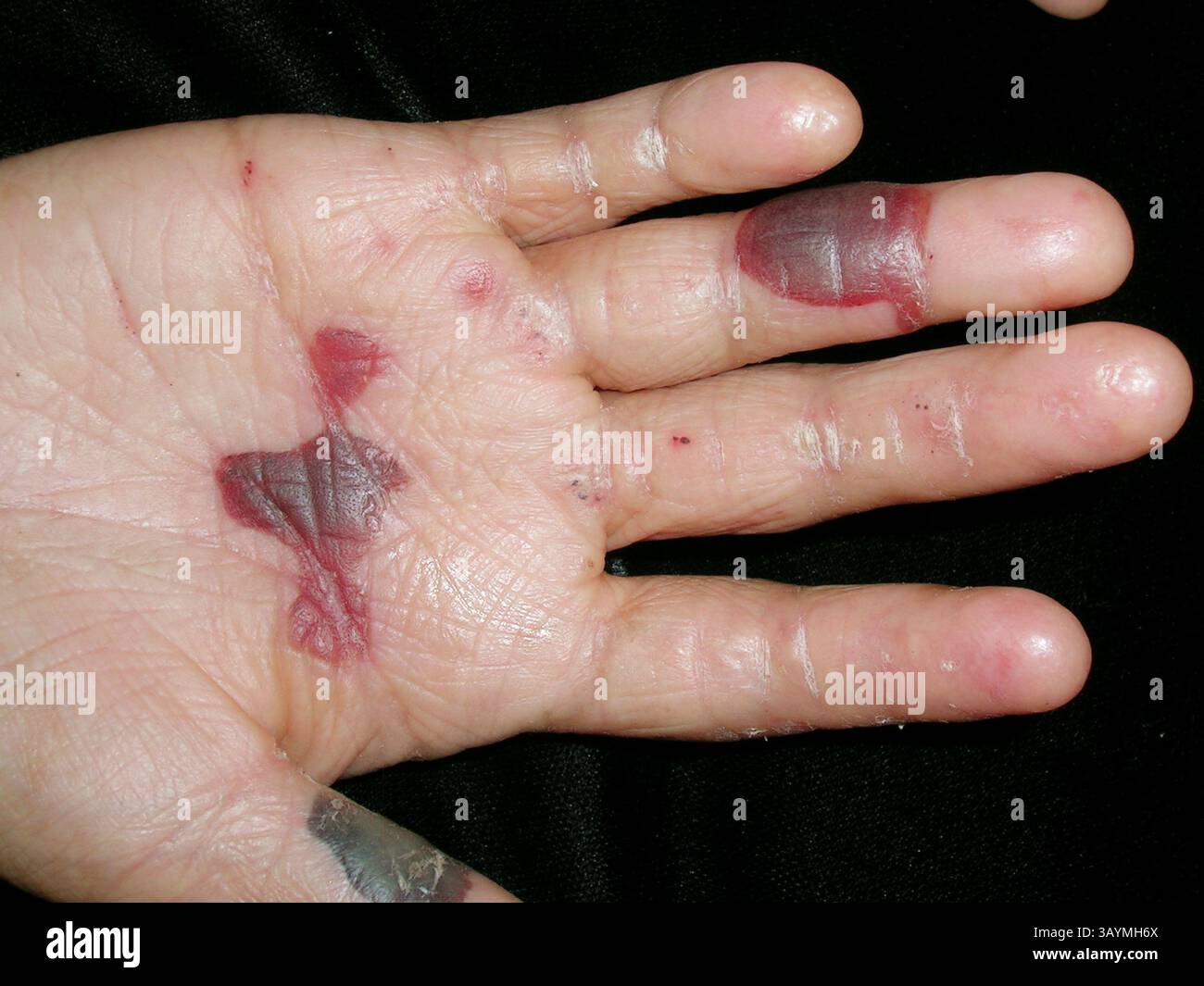 Epidermolysis bullosa (EB) blisters on the fingers and palm of a 31 ...