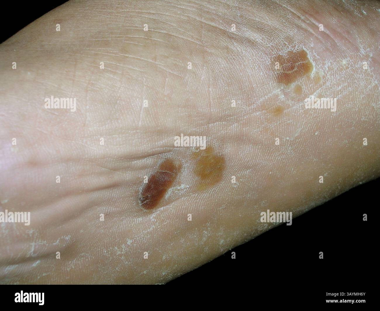 Bullous athlete's foot infection. Athlete's foot, or tinea pedis, is a ...