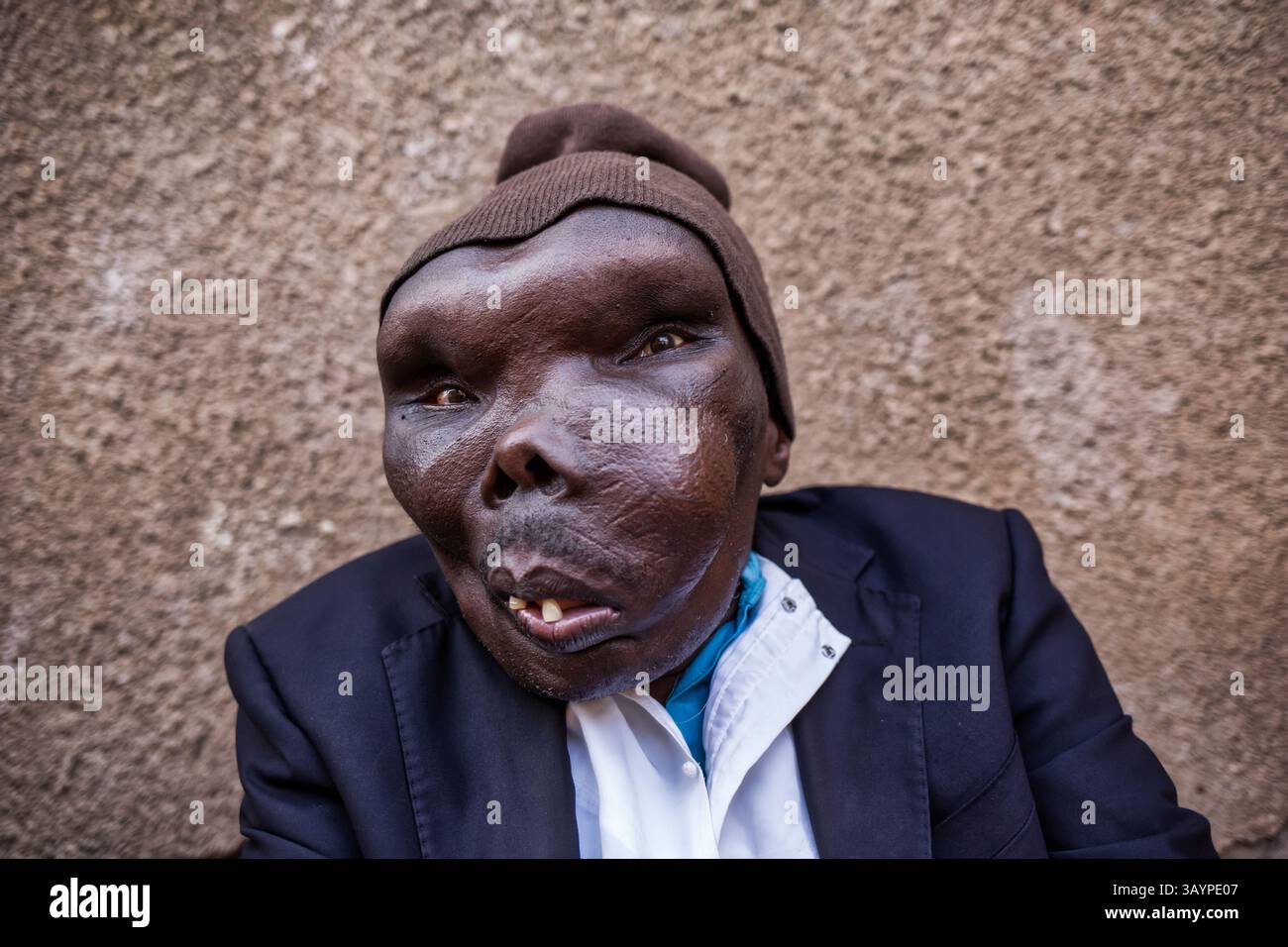 Godfrey Baguma, Sebabi, Fibrodysplasia Ossificans Progressiva (FOP ...