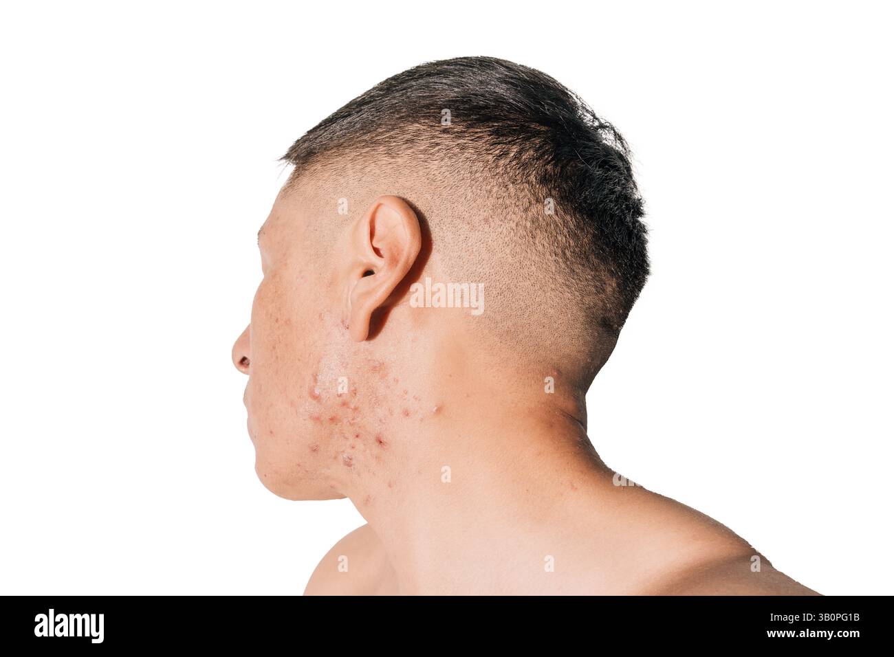 Cystic and hormonal acne on the face of a man with a white background ...