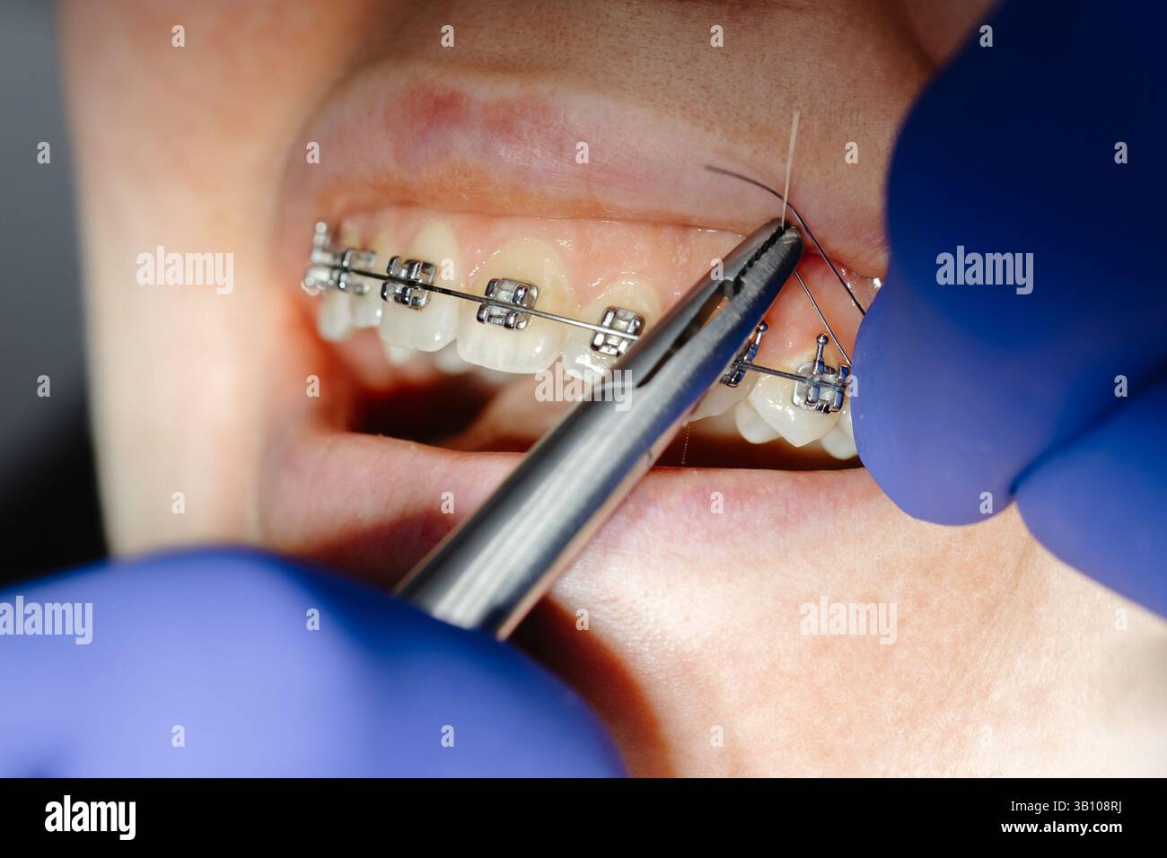 Close-up of a dentist working on a patient's teeth, installing braces ...