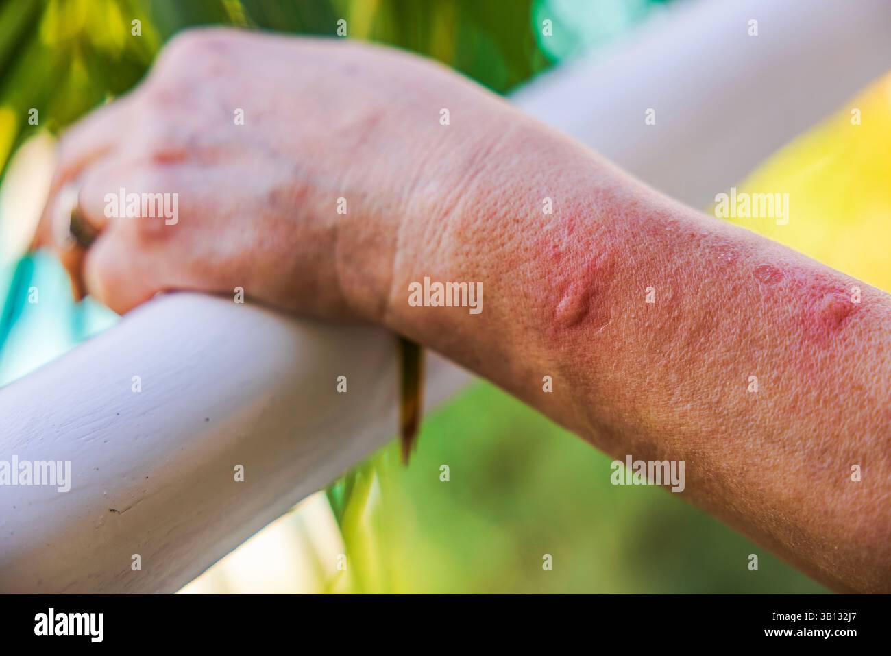 Close-up view of human forearm with multiple red insect bites and ...