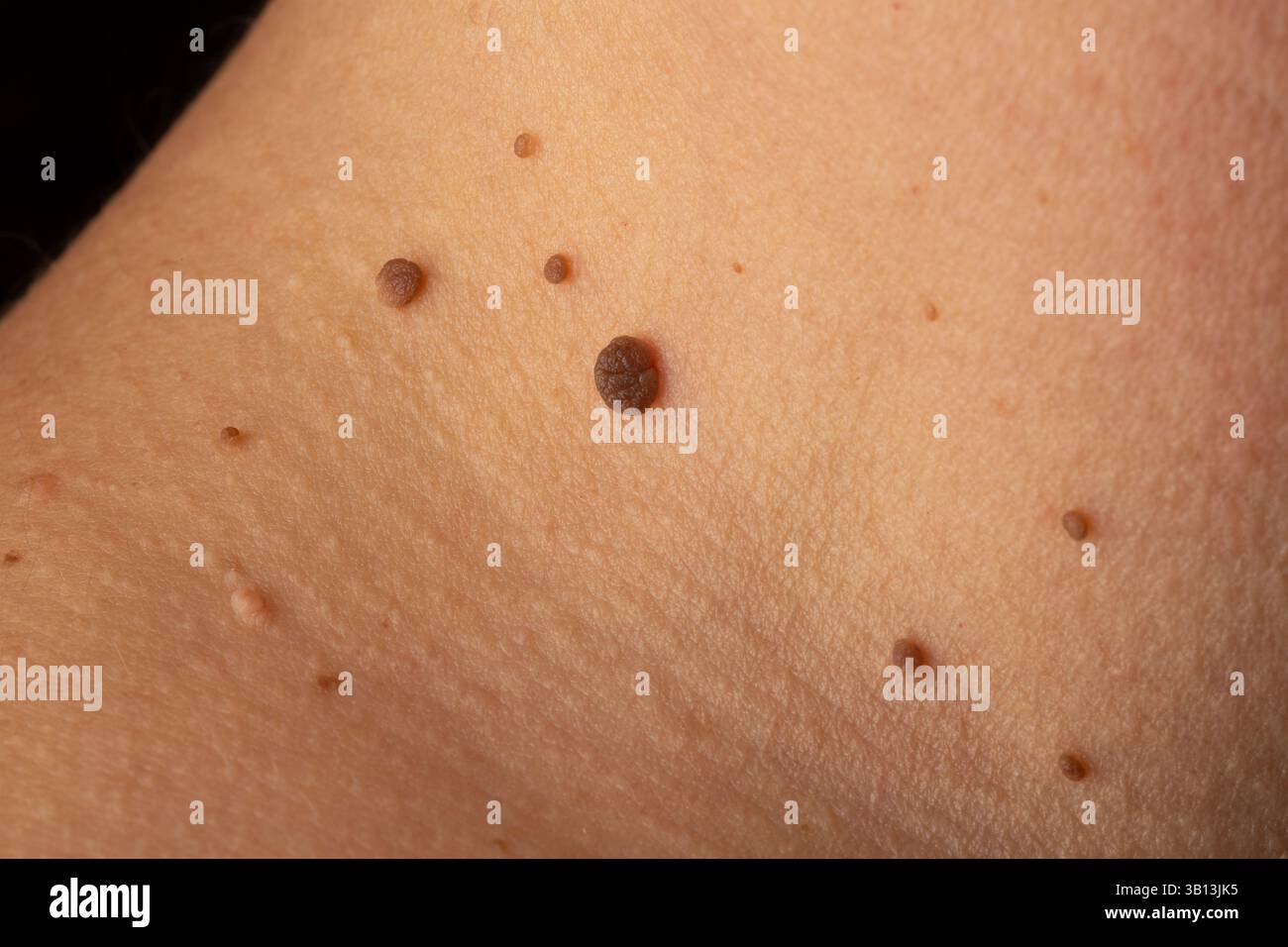 Close-up of melanocytic nevi, commonly known as moles, illustrating ...