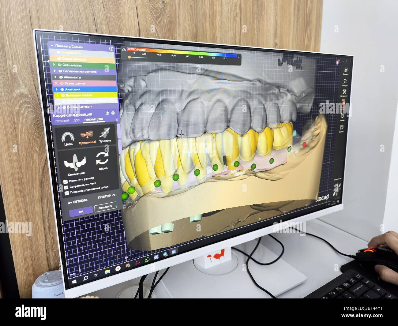 Dental design software displaying 3d teeth model on monitor screen ...
