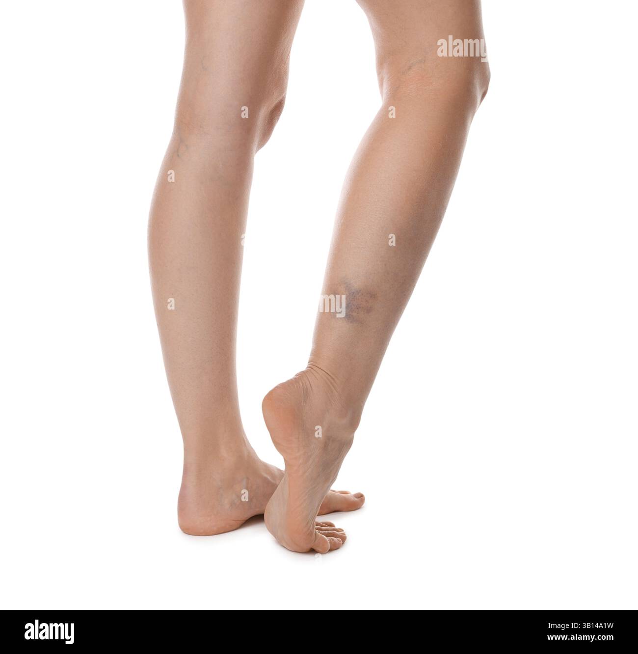 Wounded leg Cut Out Stock Images & Pictures - Alamy