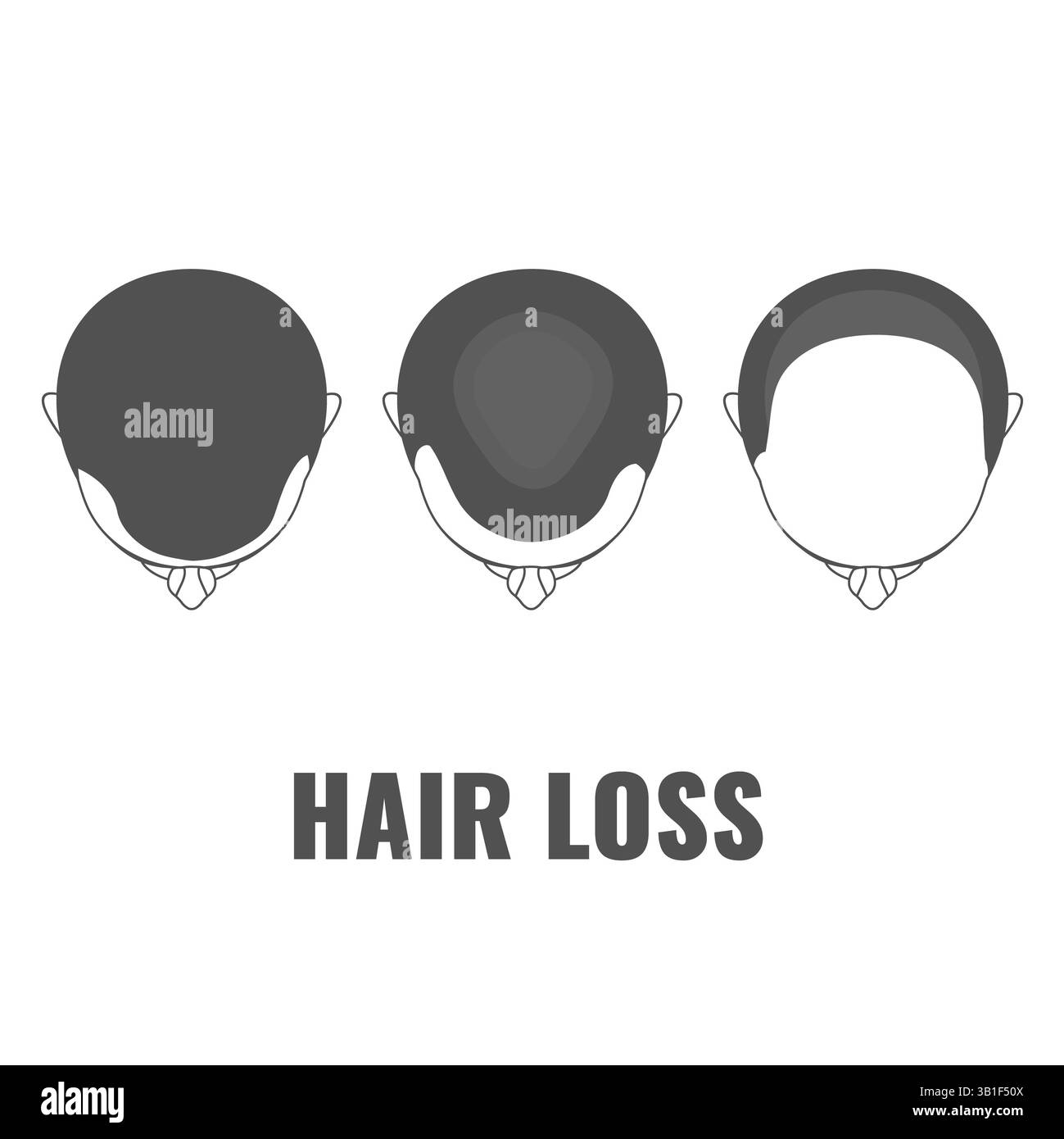 Male pattern baldness, conceptual illustration Stock Photo - Alamy