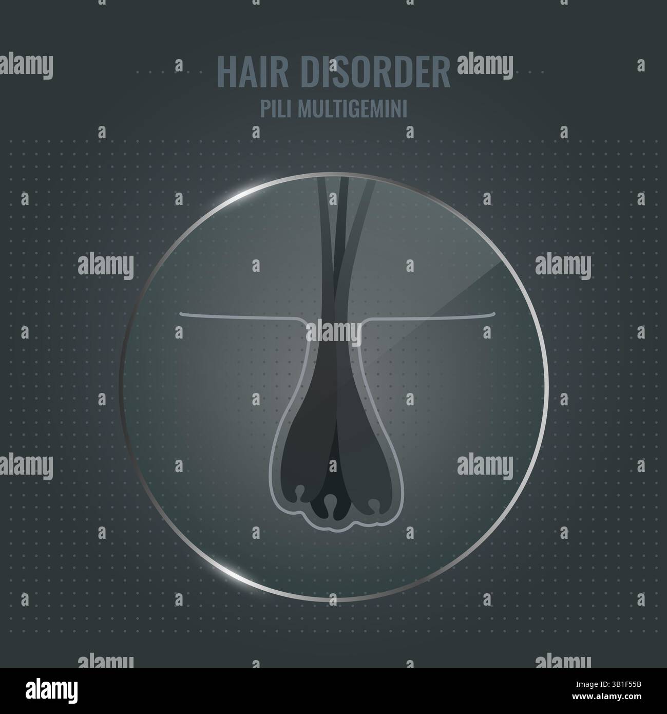 Pili multigemini hair disorder, conceptual illustration. Pili ...