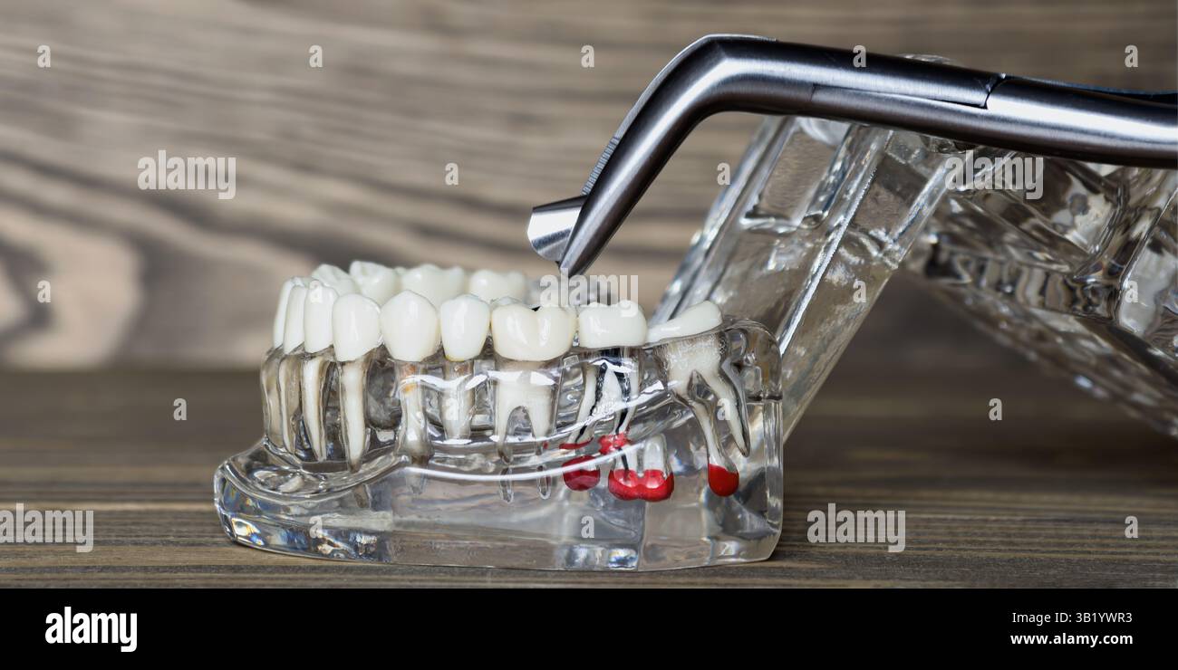 Dental root canal model with metal inspection Stock Photo - Alamy