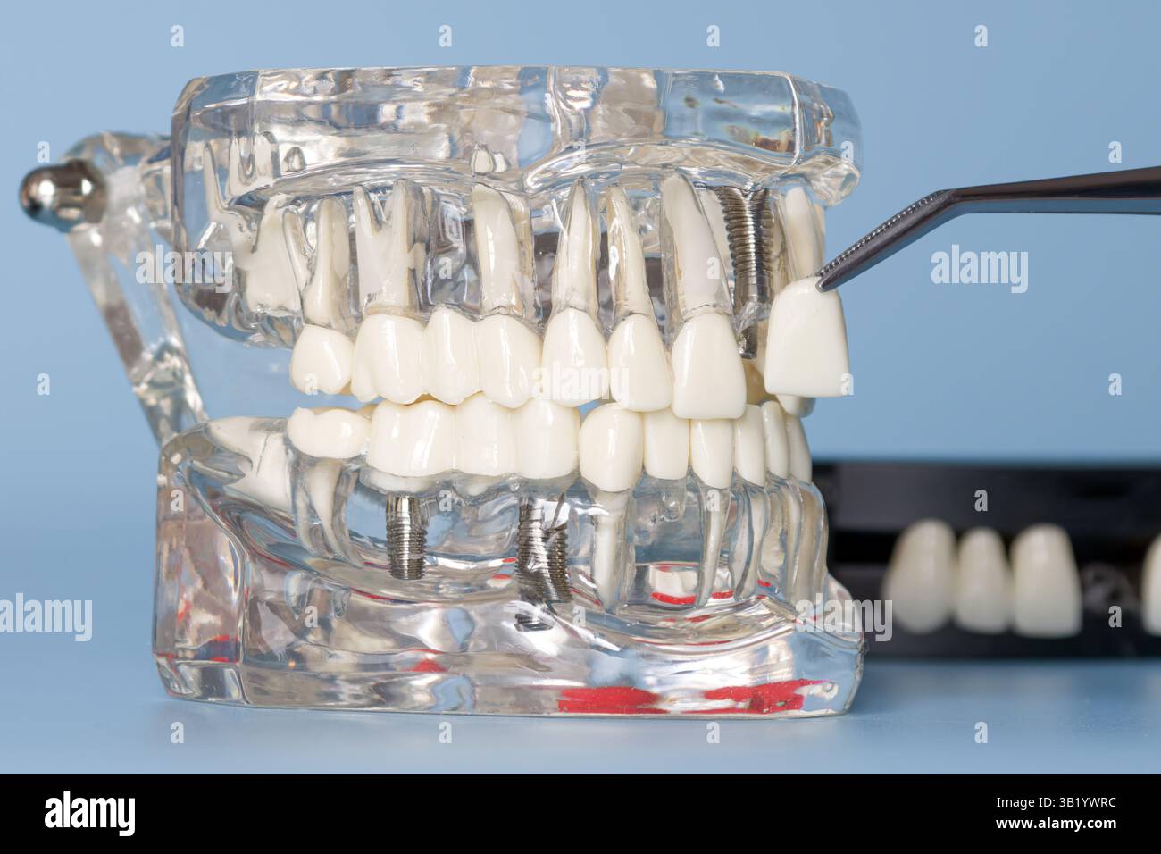 Transparent anatomical dental model showing tooth implants and a veneer ...