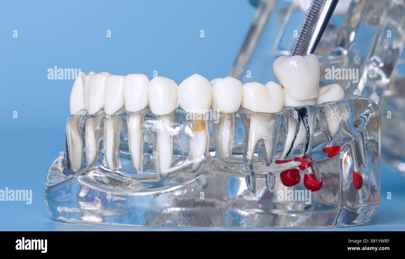 Realistic dental implant structure hi-res stock photography and images ...