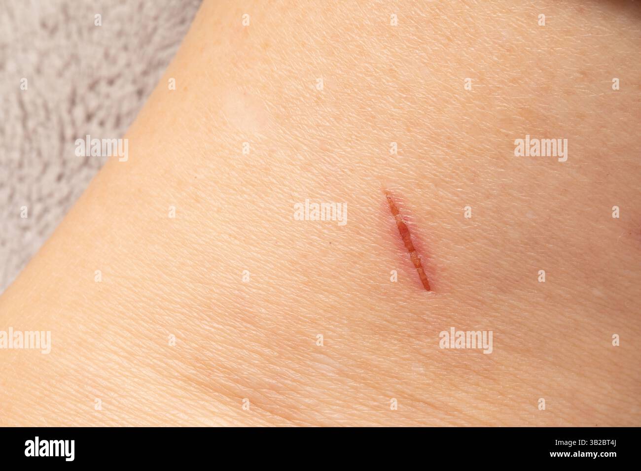 Small bleeding cut healing on human skin, concept of healthcare and ...