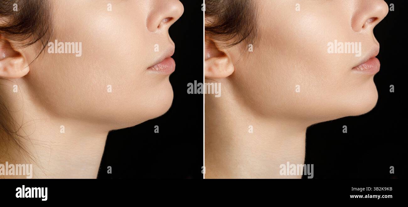 Female double chin before and after correction. Correction of the chin ...