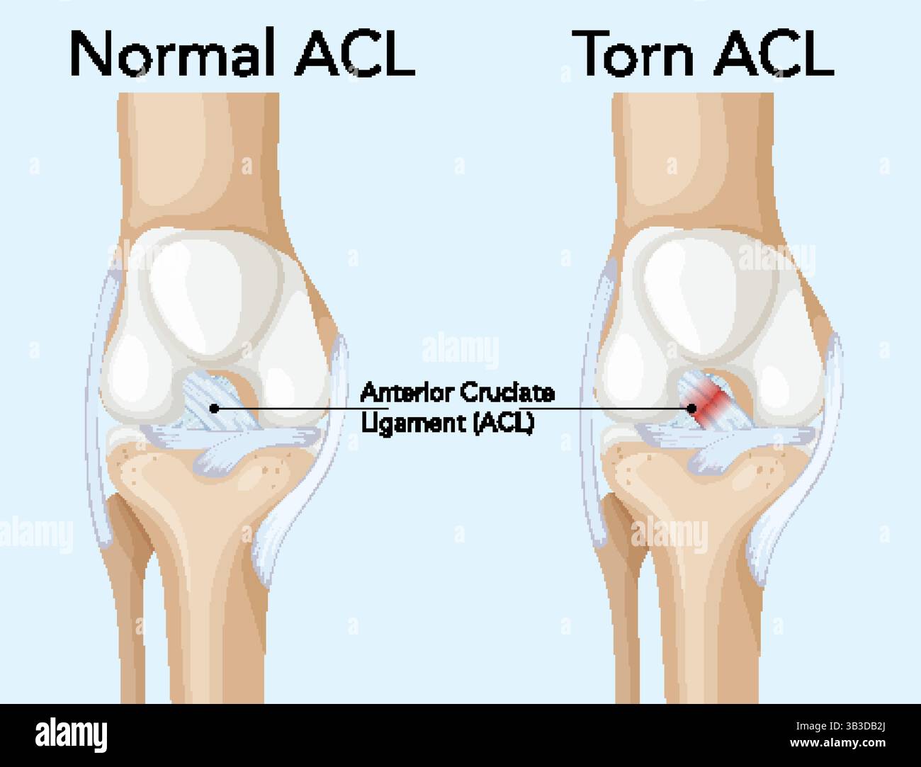 Detailed vector illustration of a normal and torn ACL in the human knee, highlighting anatomical ...