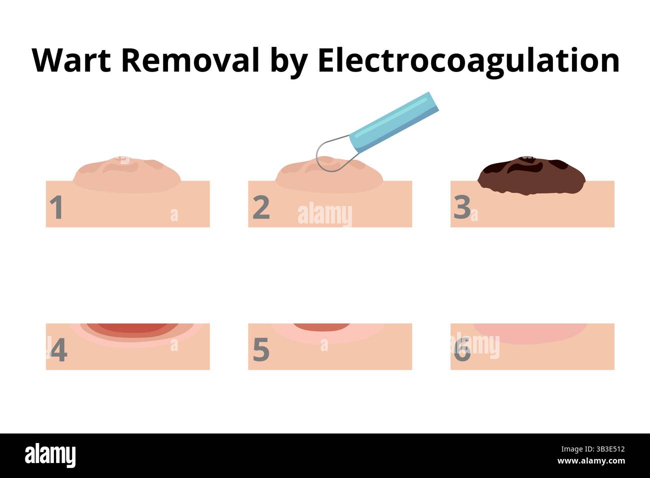 Medical illustration showing the six steps of a wart removal procedure ...