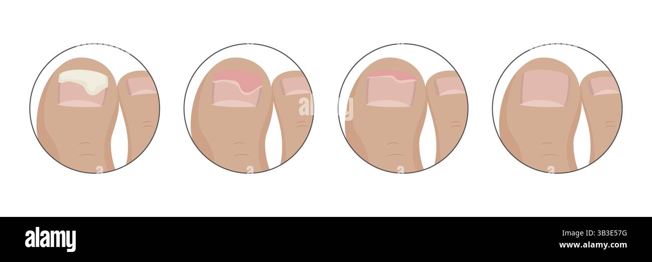 Four steps showing toenail healing from onycholysis, medical condition ...