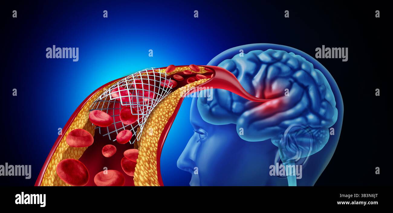 Stenting For Brain or neurovascular stents and cerebral angioplasty to ...