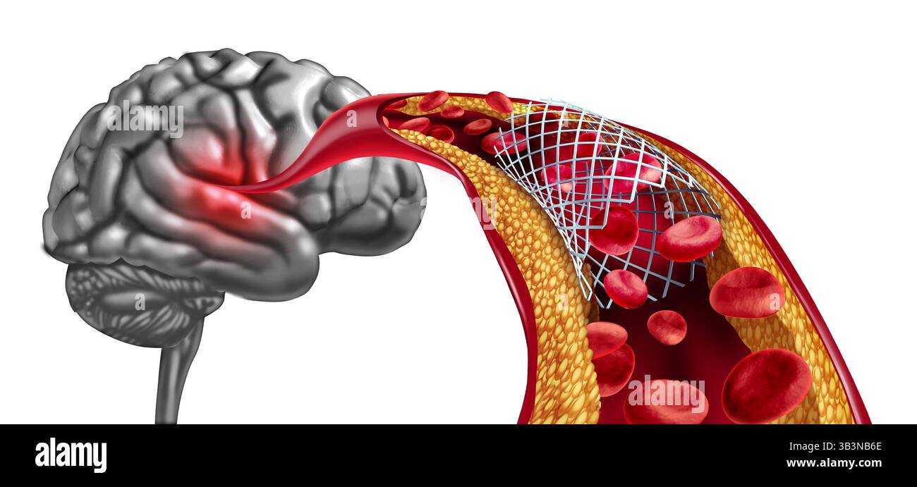 Brain Angioplasty and neurological Stenting as neurovascular stents and ...