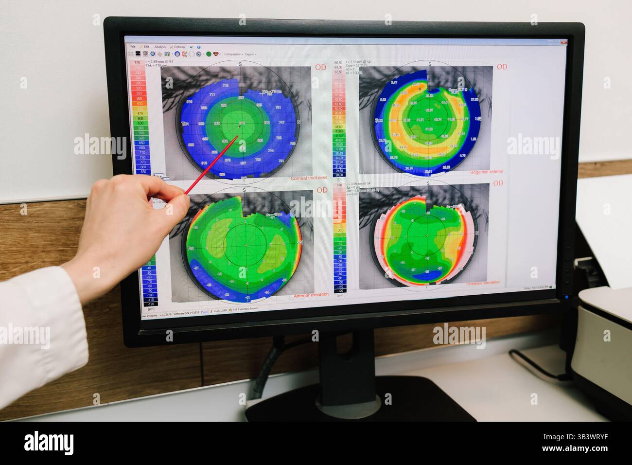 Ophthalmologist is showing corneal topography scan to girl patient near ...