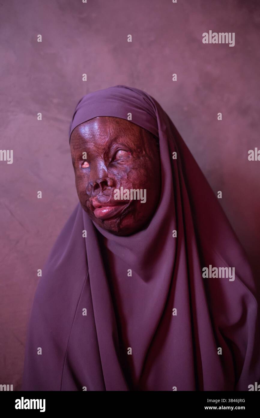 Acid attack survivors in Uganda, Africa Stock Photo - Alamy