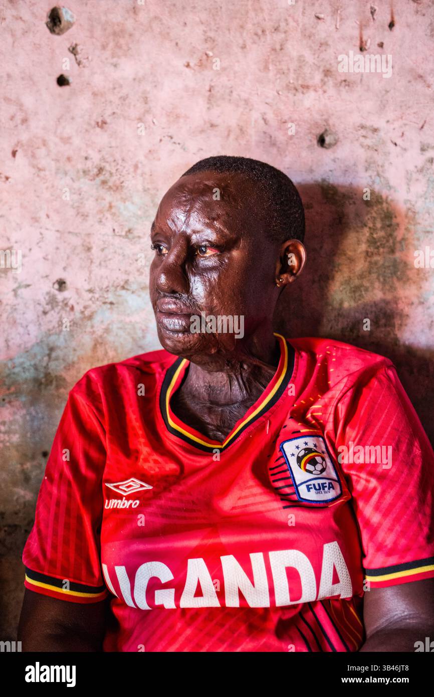 Acid attack survivors in Uganda, Africa Stock Photo - Alamy