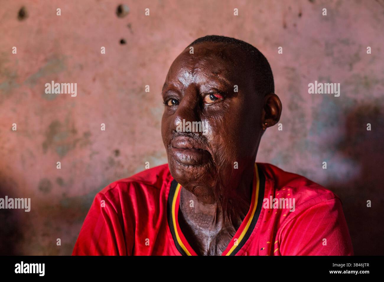 Acid attack survivors in Uganda, Africa Stock Photo - Alamy