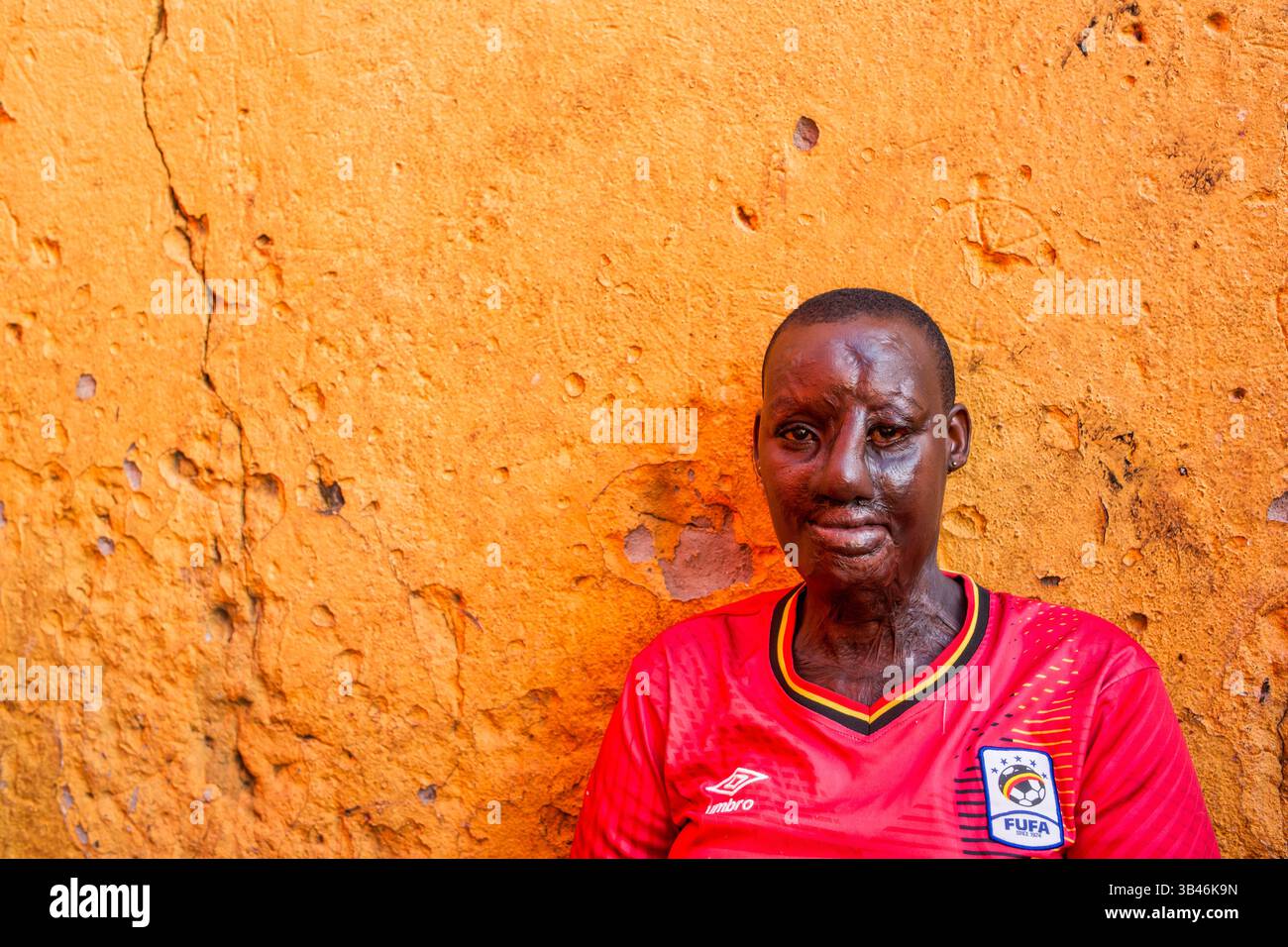 Acid attack survivors in Uganda, Africa Stock Photo - Alamy