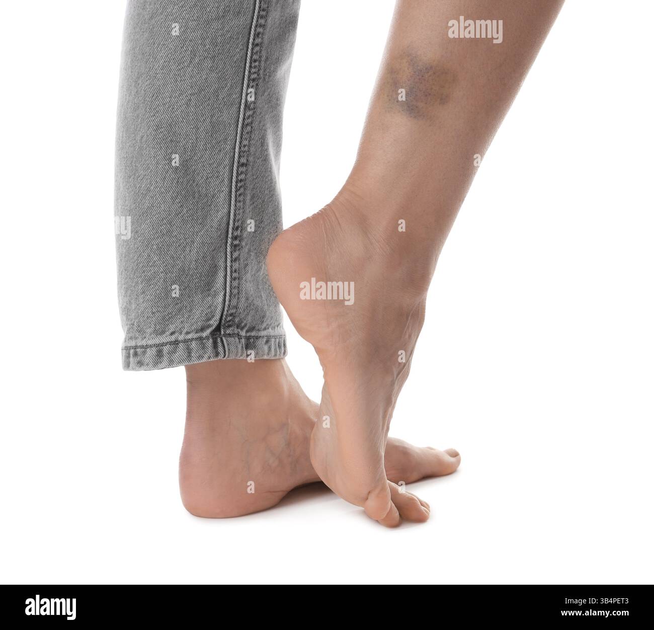 Woman with bruise on leg against white background, closeup Stock Photo ...