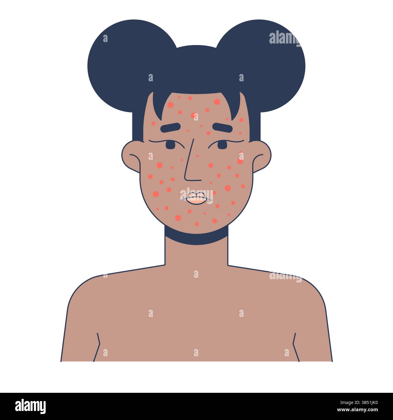 Black woman face with severe acne 2D vector illustration Stock Vector ...