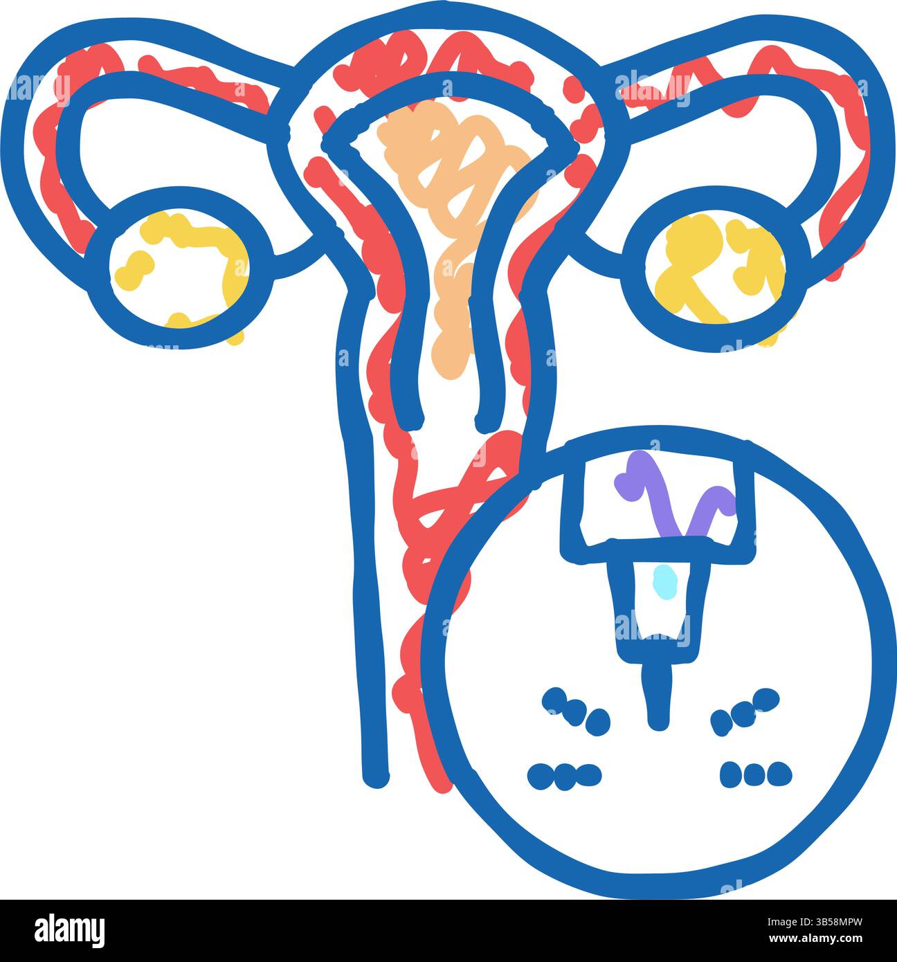Uterus medical laser treatment color hi-res stock photography and ...