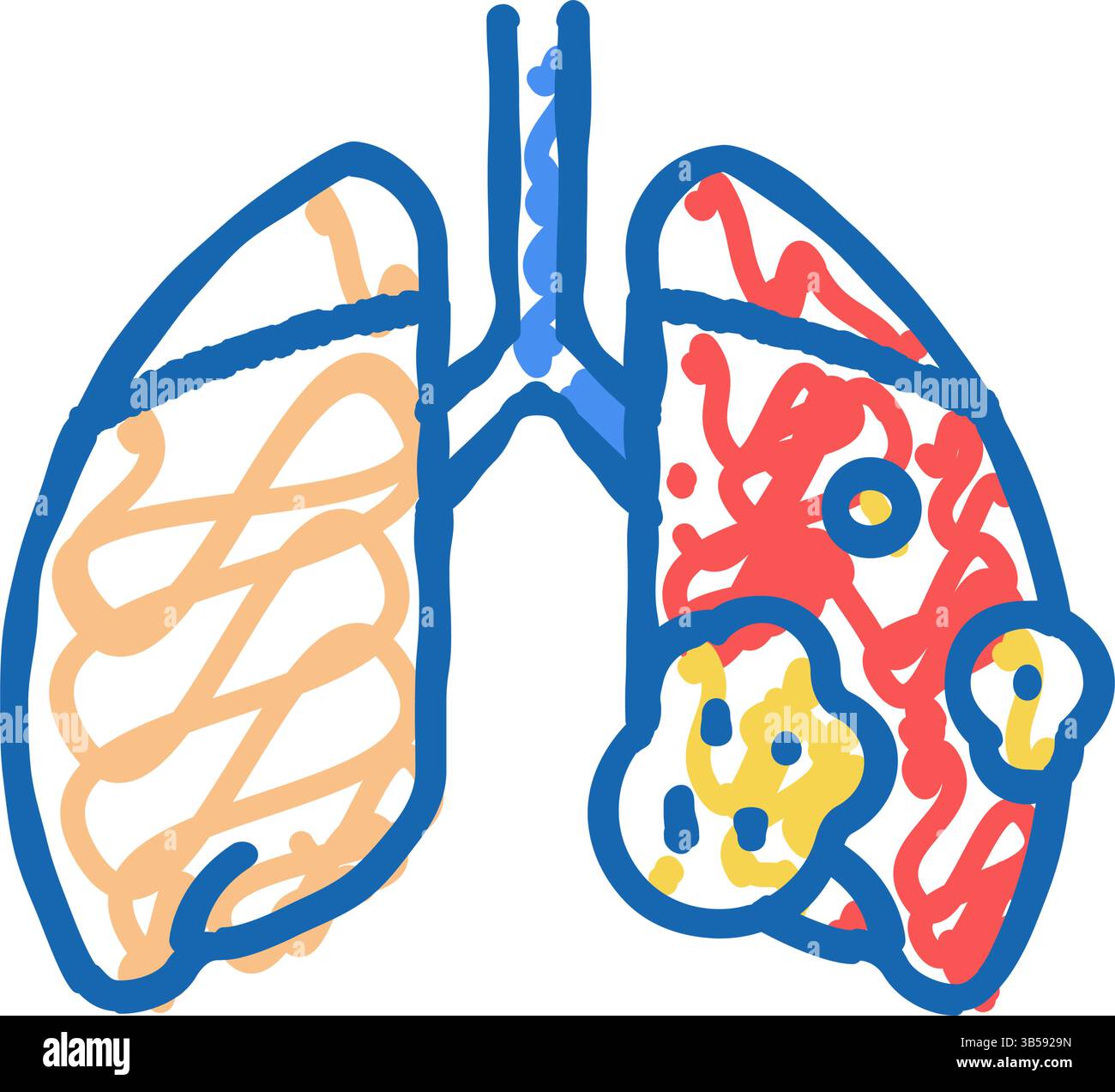 acute respiratory distress syndrome icon doodle illustration Stock ...
