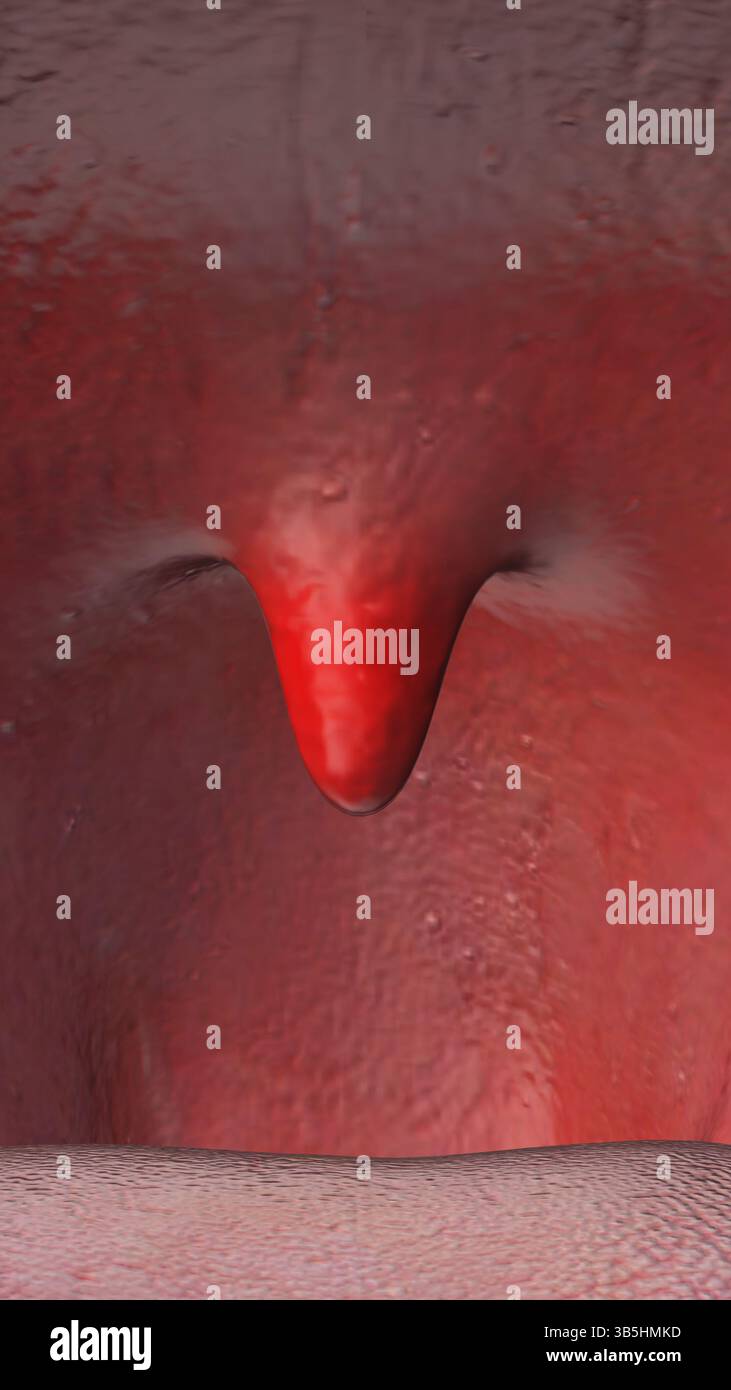 Close-up of a swollen uvula inside a human mouth Stock Photo - Alamy