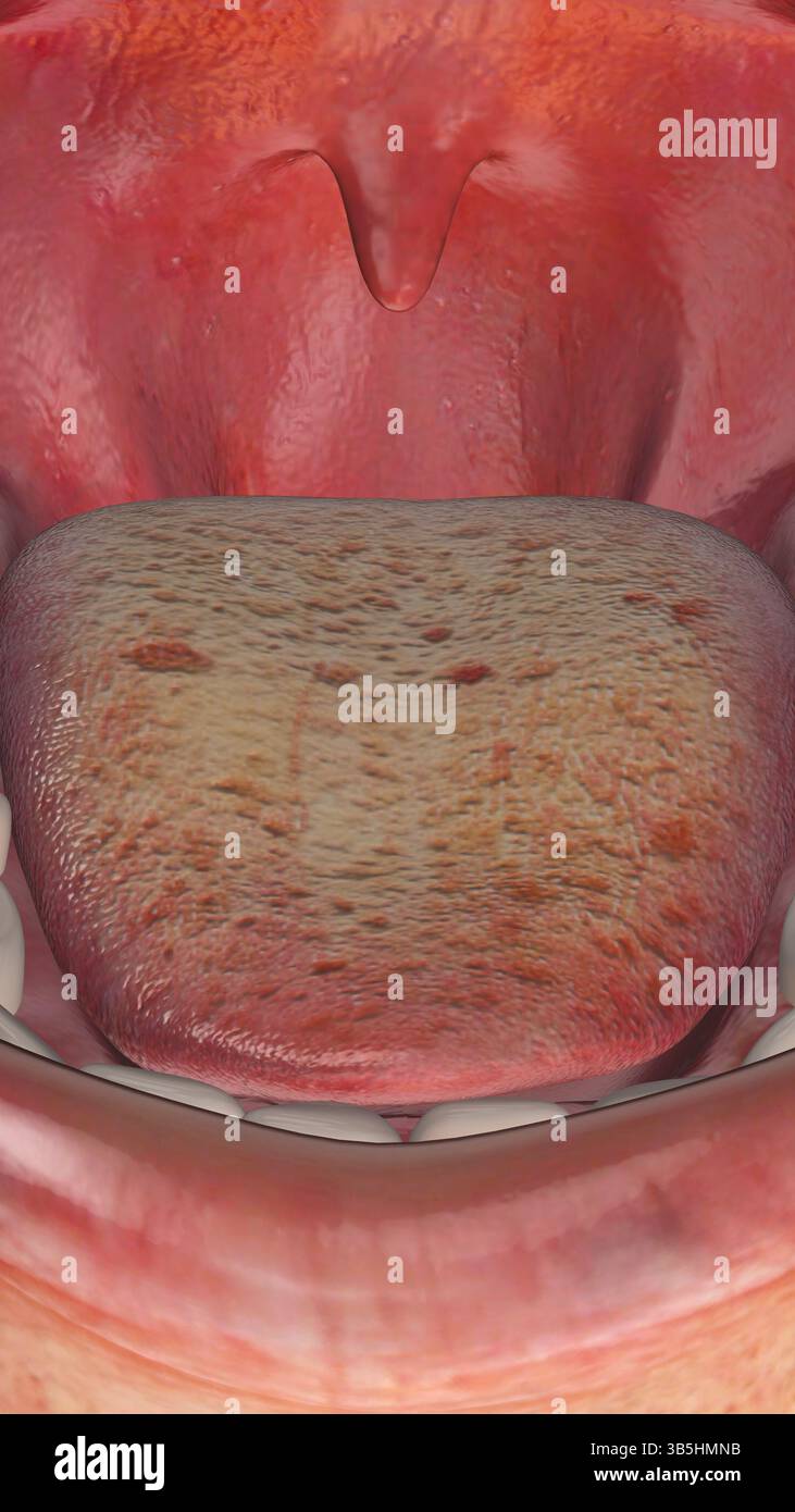 Close-Up of Fungal Infection on Human Tongue Stock Photo - Alamy