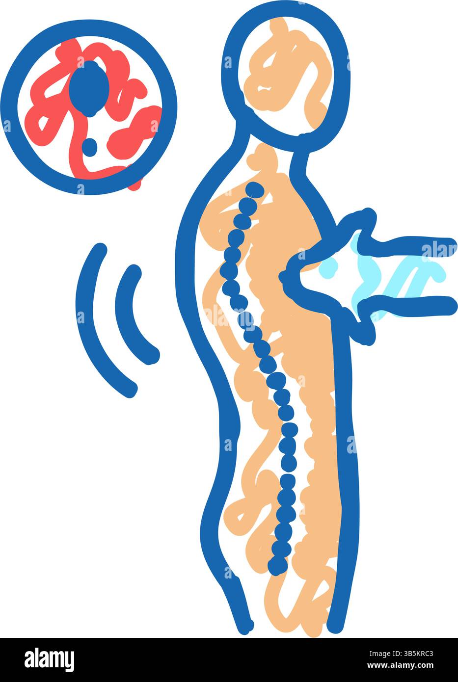 kyphosis disease icon doodle illustration Stock Vector Image & Art - Alamy